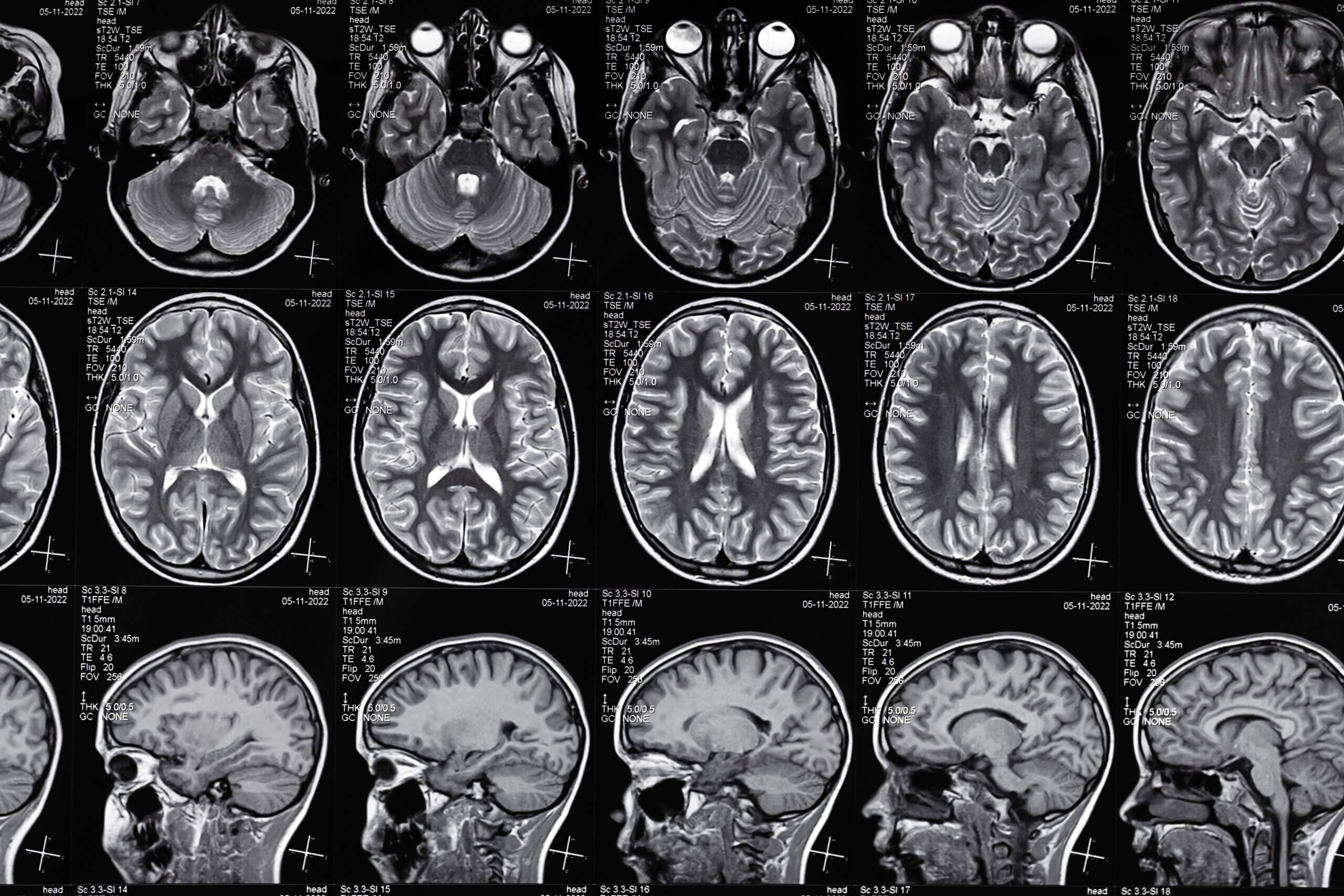 Types d'accidents entraînant un traumatisme crânien