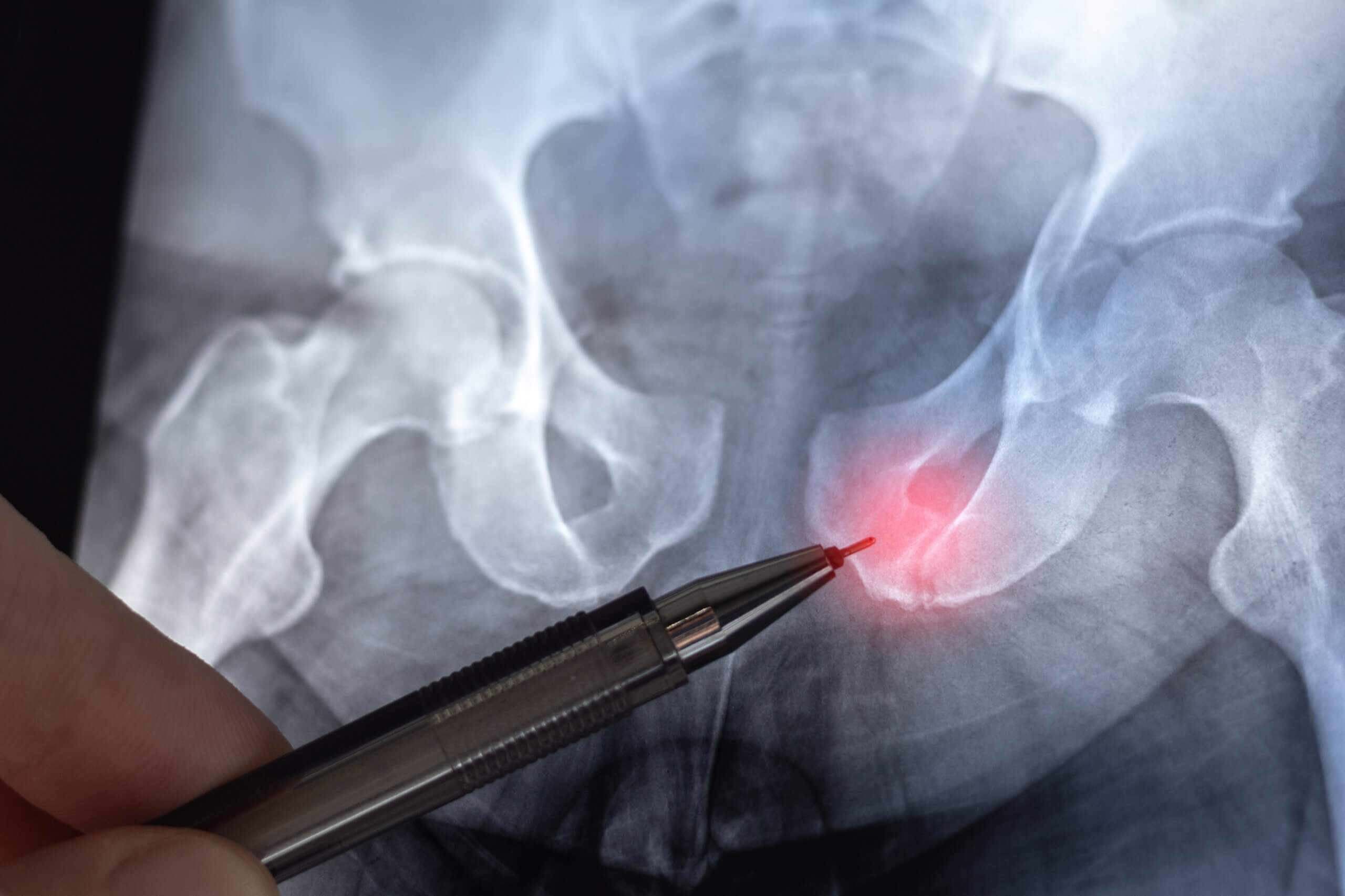Car Accidents and Hidden Pelvic Injuries: What Victims Should Know - Hillstone Law Accident ...